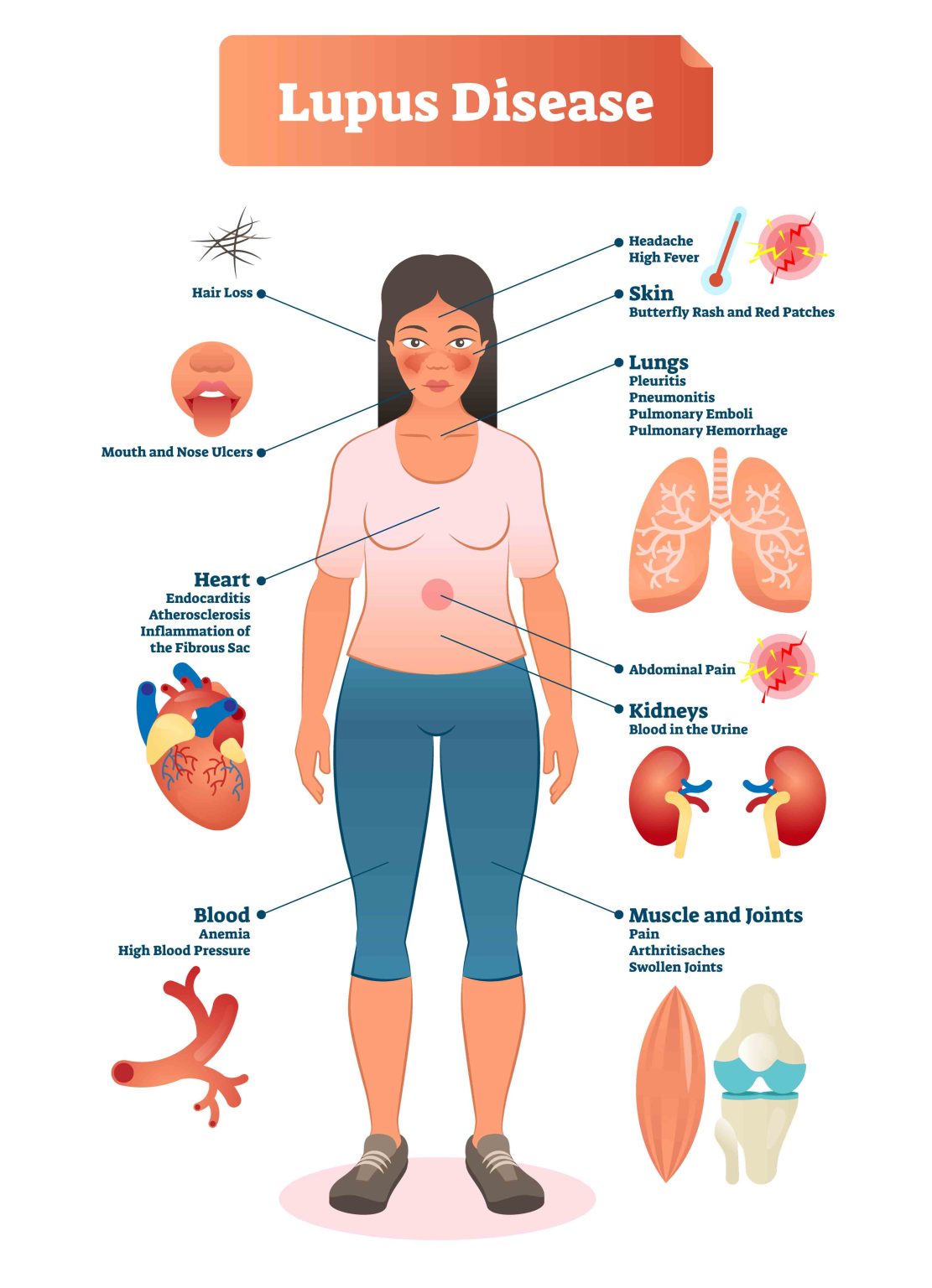 Holistic Treatment for Lupus